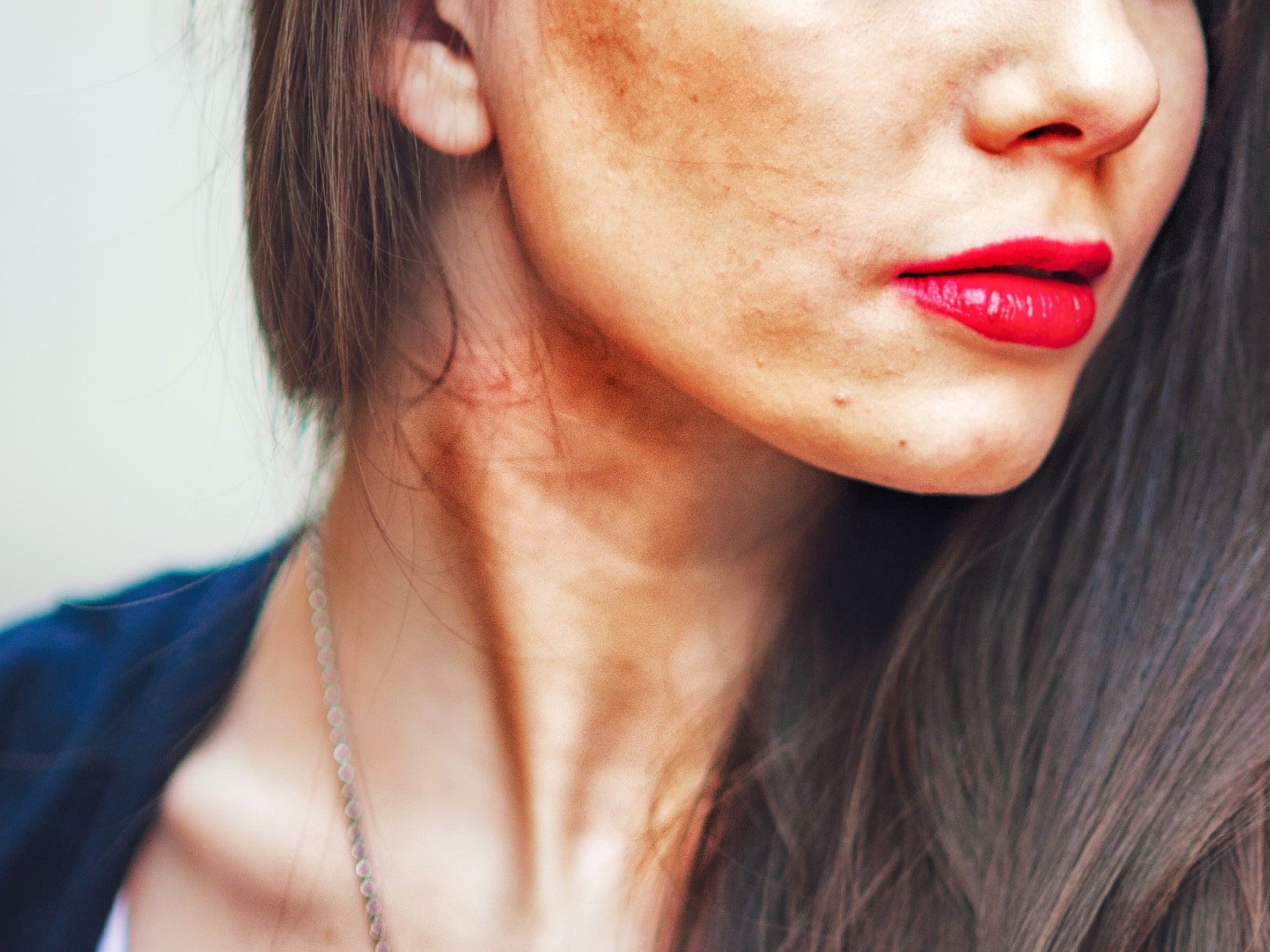 Does Hyperpigmentation Fade Away Naturally? – Balmonds