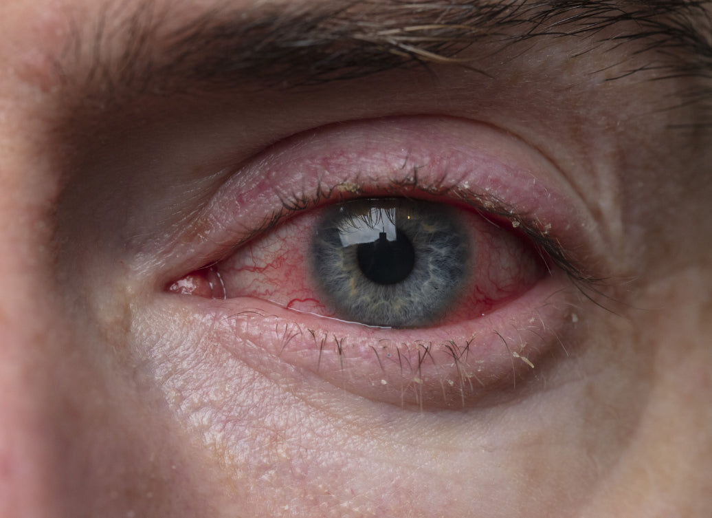 What Is The Main Cause Of Blepharitis? – Balmonds