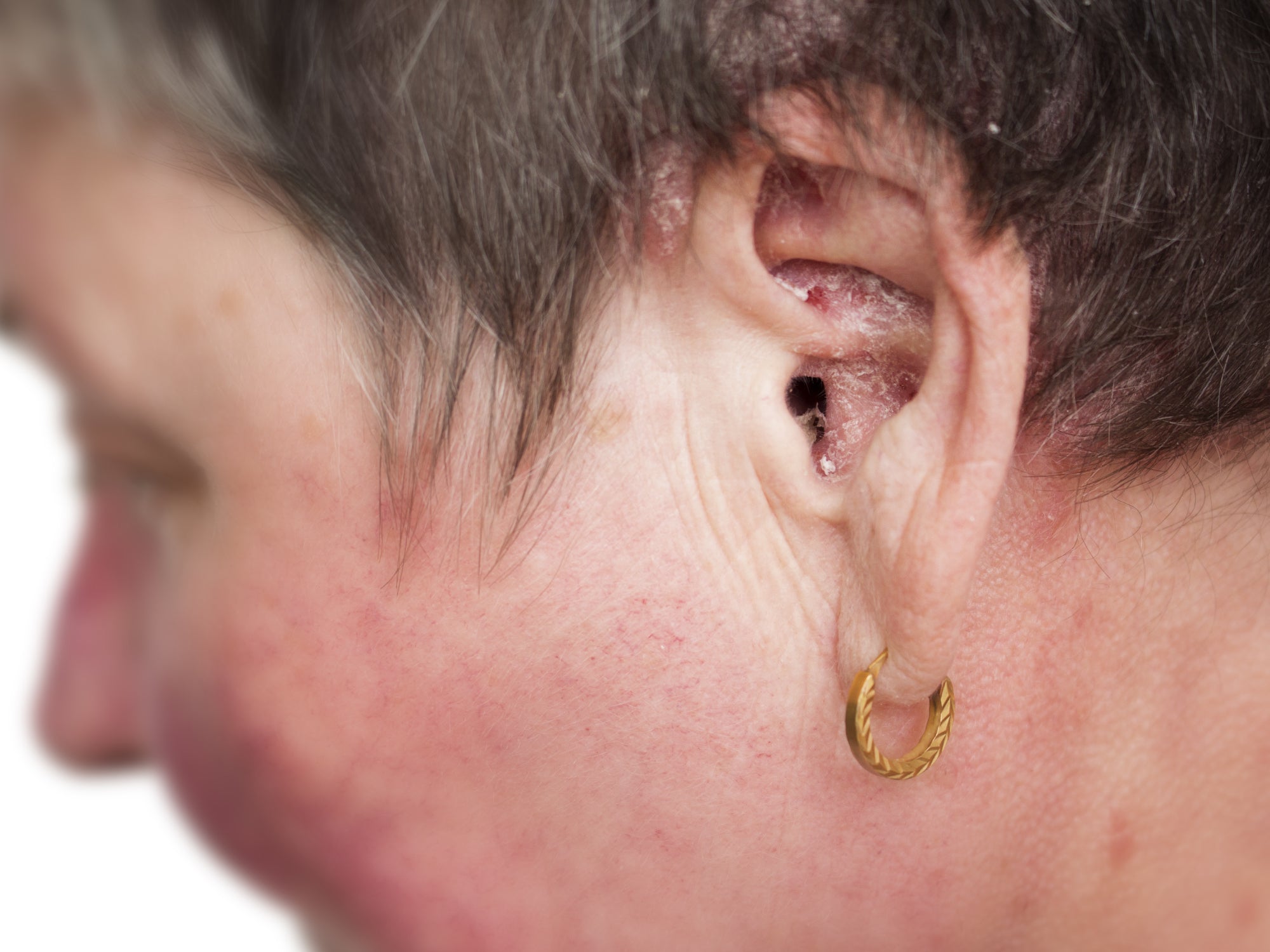 Can You Cure Aural Dermatitis/Ear Eczema? – Balmonds