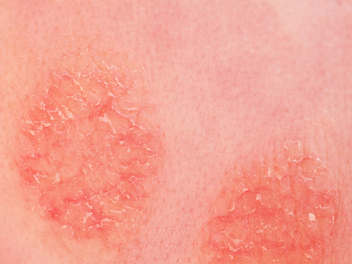 Does Discoid Eczema Leave Scars? – Balmonds