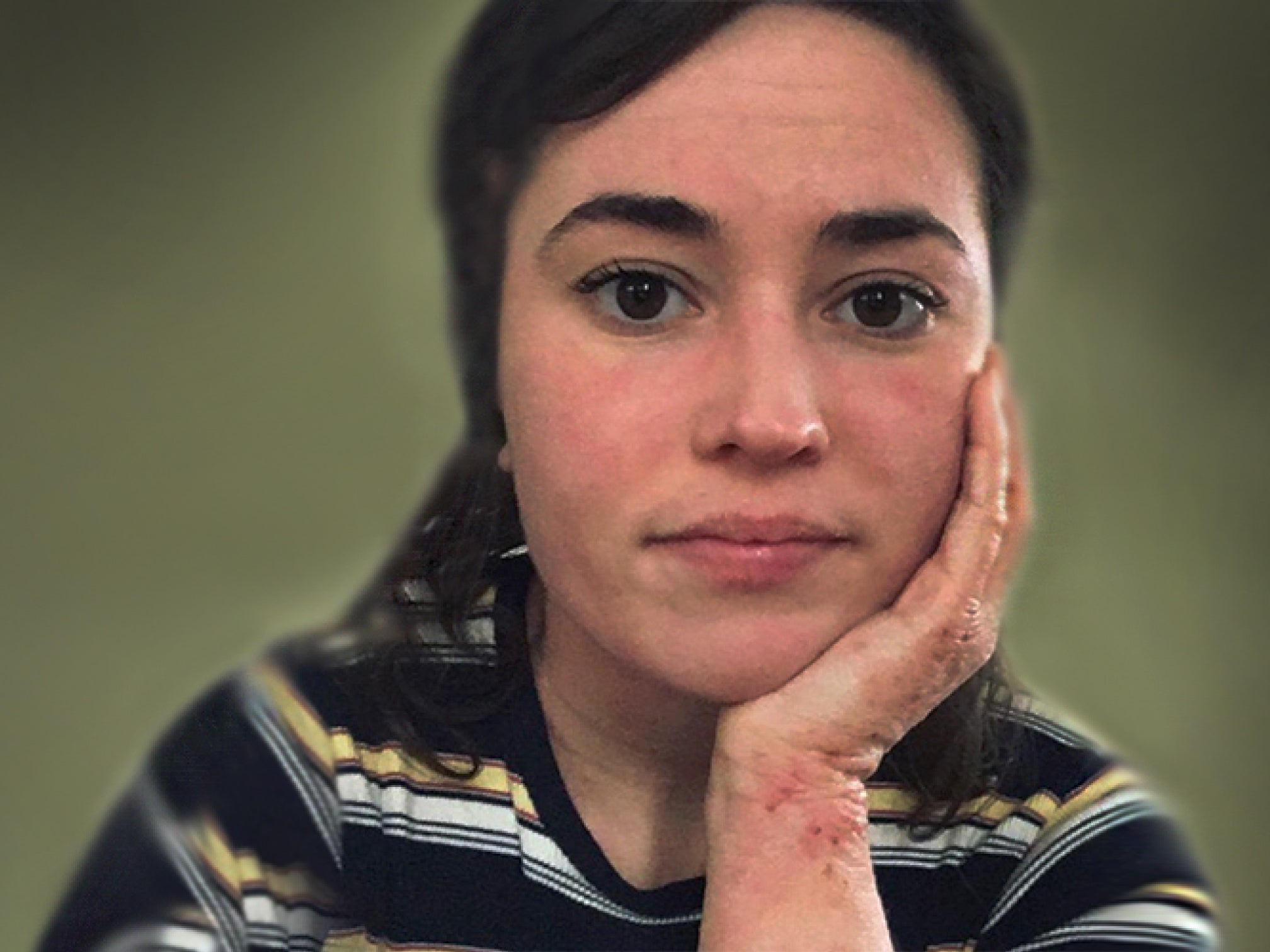 What Are The Stages Of Topical Steroid Withdrawal? – Balmonds