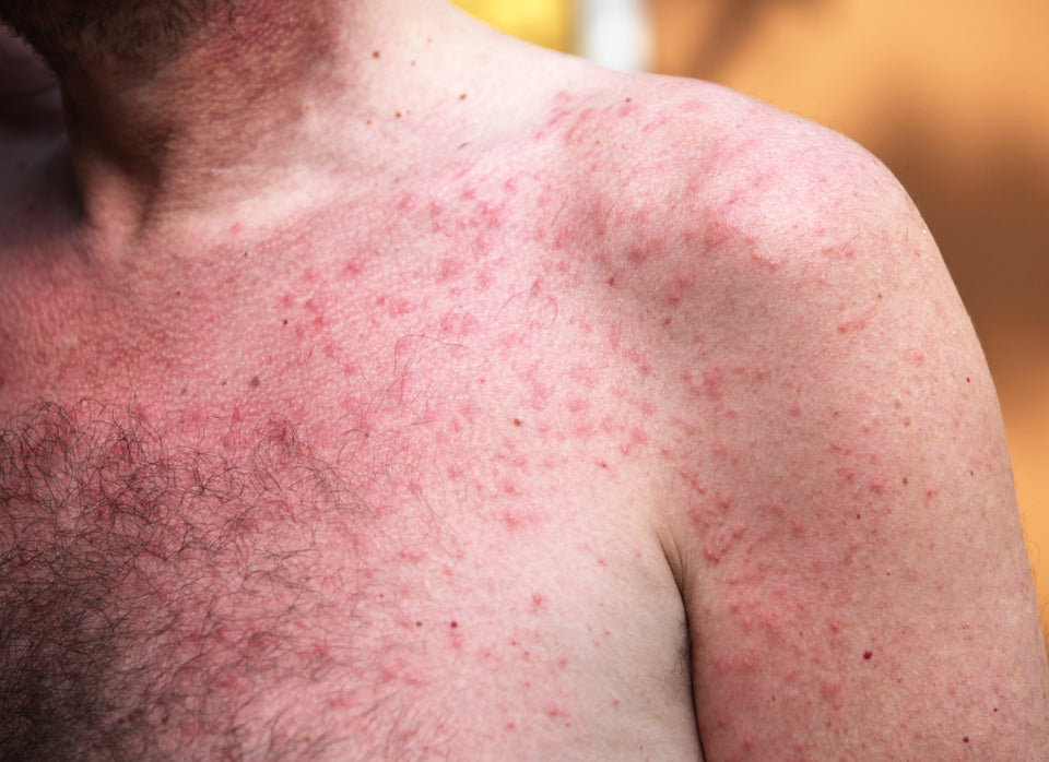 Polymorphic Light Eruption (PMLE) – Balmonds