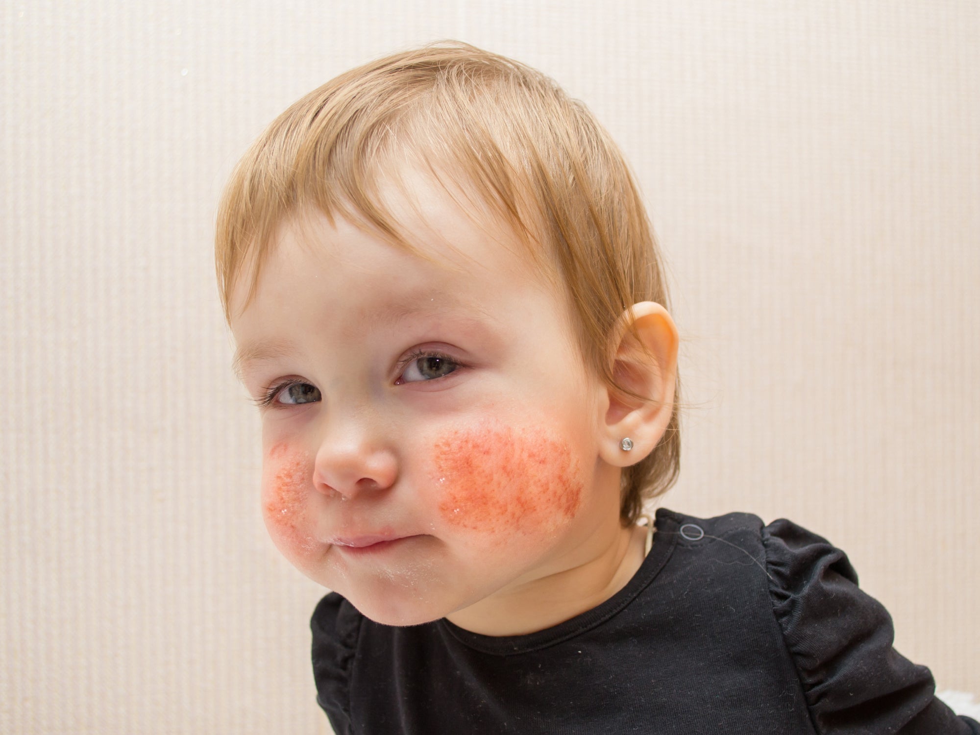Best Natural Non-Sting Cream For Perioral Dermatitis In Toddlers – Balmonds