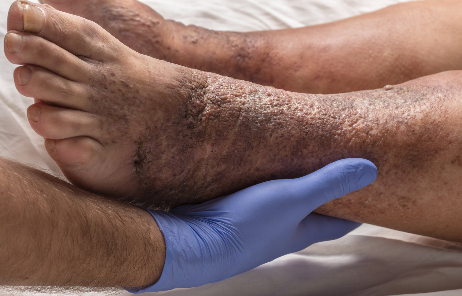 What Does Venous Stasis Dermatitis Look Like? – Balmonds