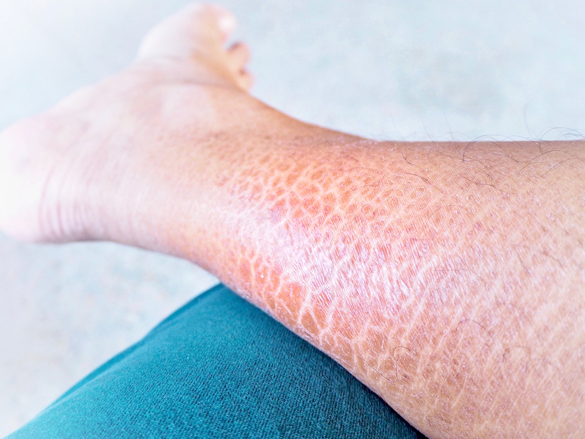 How Is Ichthyosis Inherited? – Balmonds