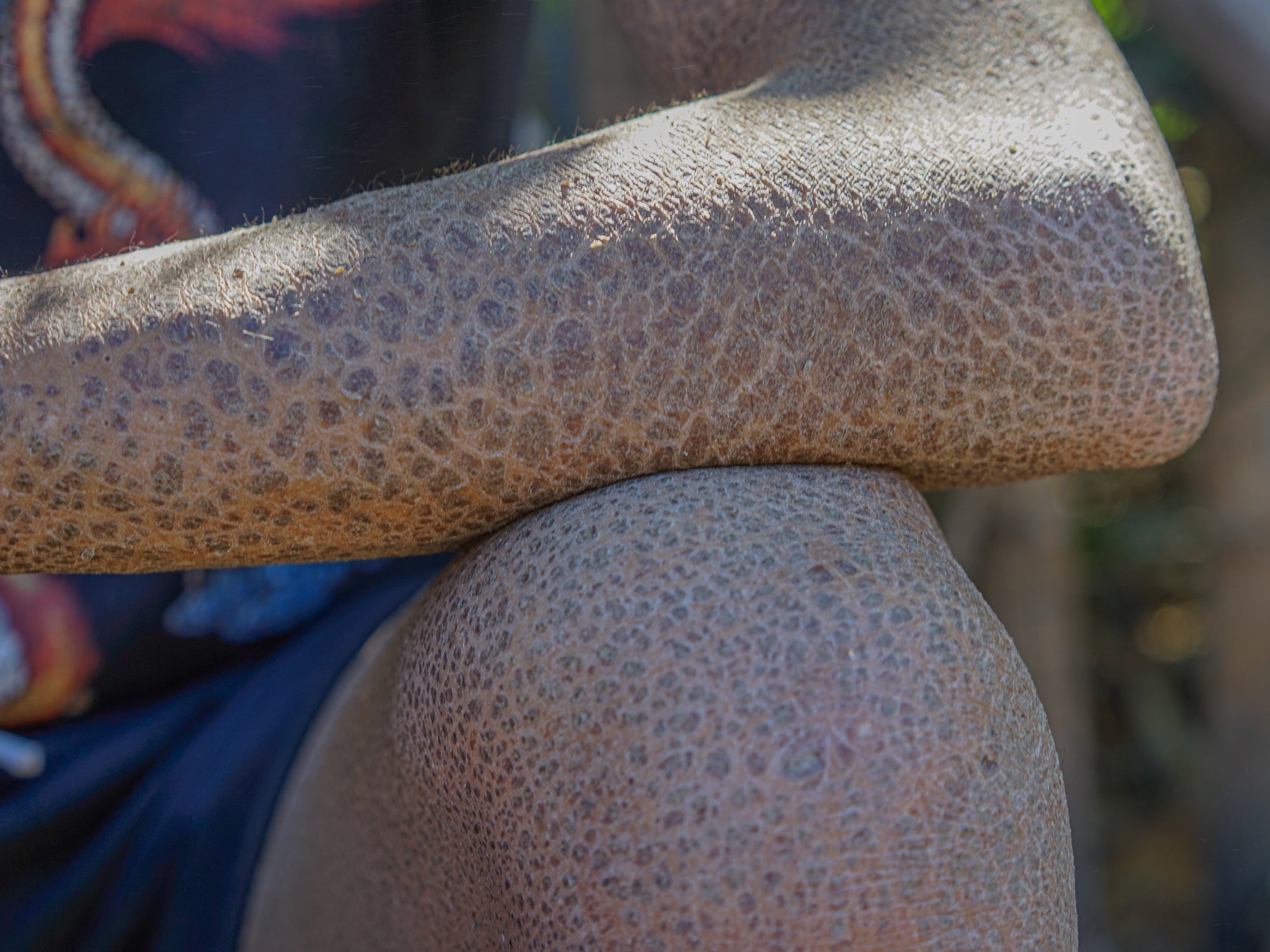 What Causes Ichthyosis Skin Disorder? – Balmonds